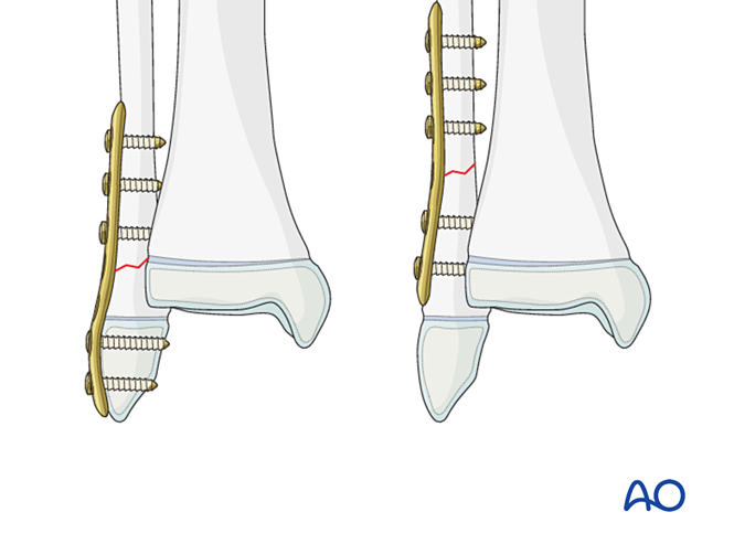 Open reduction; plate fixation for Complete fractures of the distal ...