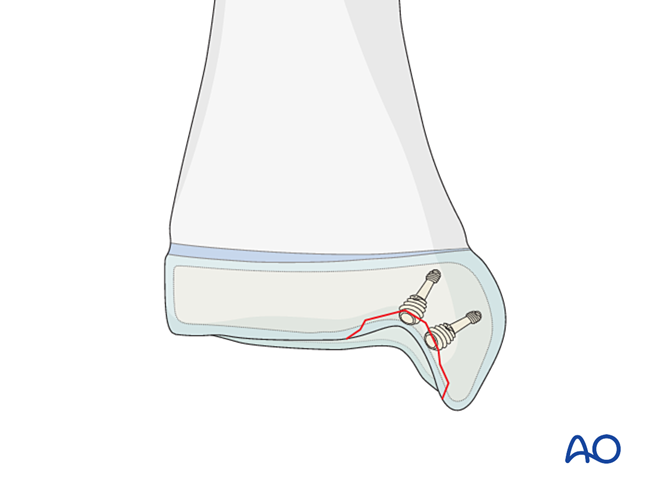 Open reduction; pin or screw fixation for Osteochondral fractures ...