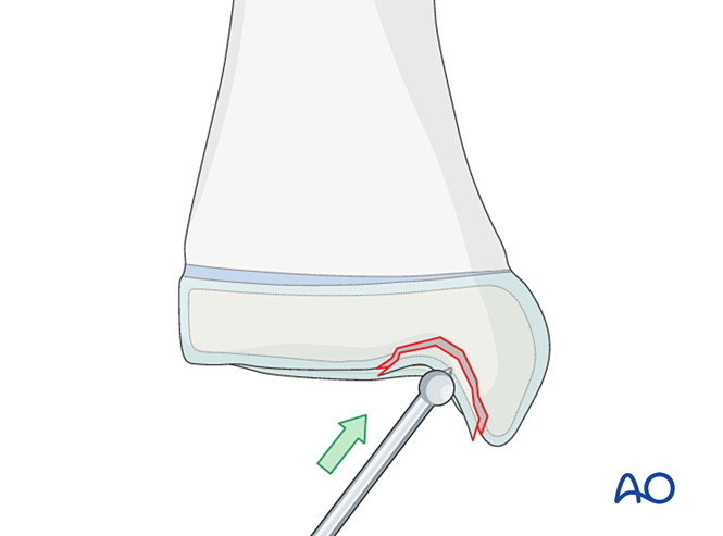 Open reduction; pin or screw fixation for Osteochondral fractures ...