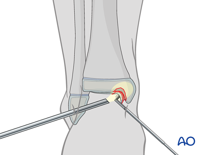 Open reduction; pin or screw fixation for Osteochondral fractures ...