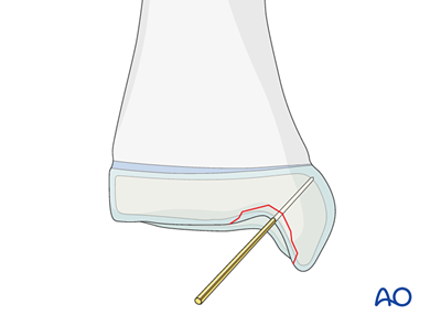 Open reduction; pin or screw fixation for Osteochondral fractures ...