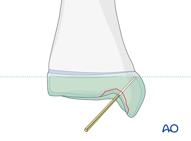 Open reduction; pin or screw fixation for Osteochondral fractures ...