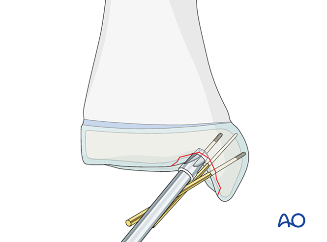 Open reduction; pin or screw fixation for Osteochondral fractures ...