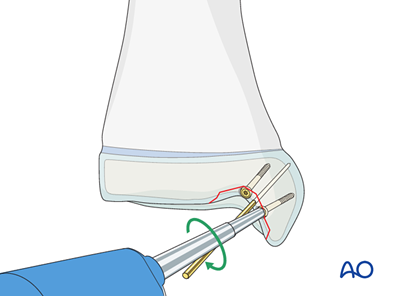 Open reduction; pin or screw fixation for Osteochondral fractures ...