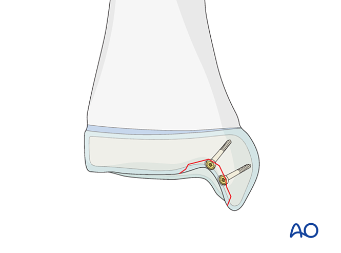 Open reduction; pin or screw fixation for Osteochondral fractures ...