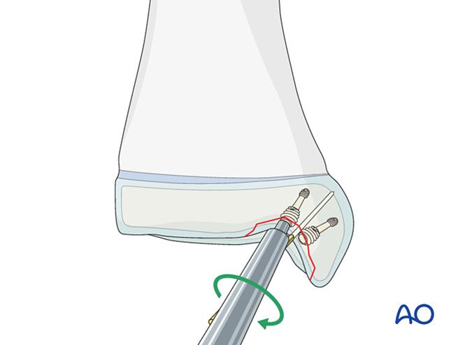 Open reduction; pin or screw fixation for Osteochondral fractures ...