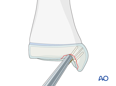 Open reduction; pin or screw fixation for Osteochondral fractures ...