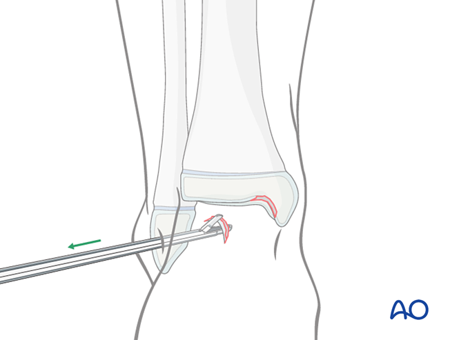 Excision for Osteochondral fractures (intraarticular flake) of the ...