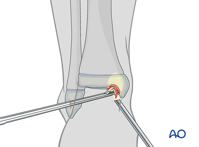 Excision for Osteochondral fractures (intraarticular flake) of the ...