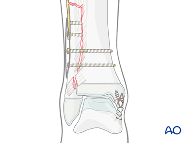 Syndesmotic transfixation with screws for Syndesmotic injuries