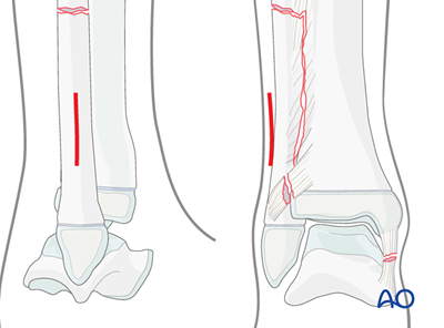 Syndesmotic transfixation with screws for Syndesmotic injuries