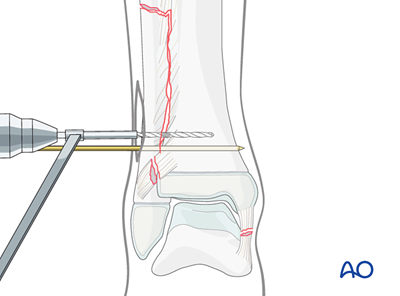 Syndesmotic transfixation with screws for Syndesmotic injuries