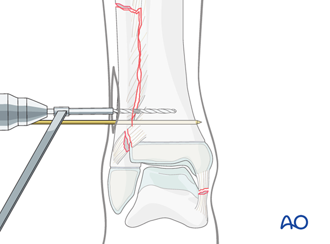 Syndesmotic transfixation with suture and button (suspensory fixation ...