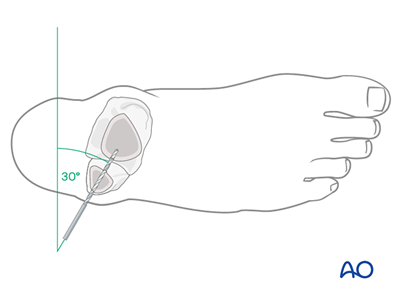 Syndesmotic transfixation with screws for Syndesmotic injuries