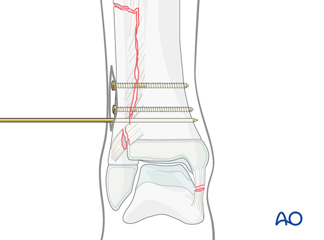 Syndesmotic transfixation with screws for Syndesmotic injuries