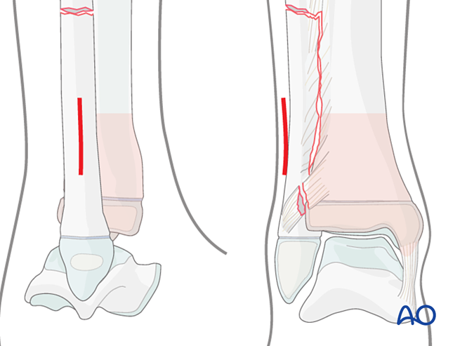 Syndesmotic stabilization