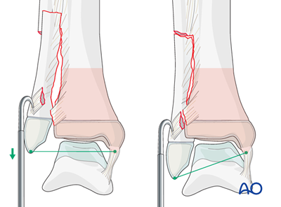 Syndesmotic stabilization