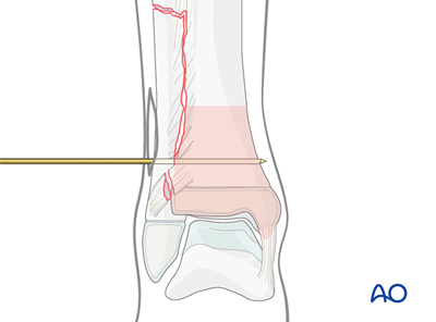 Syndesmotic stabilization