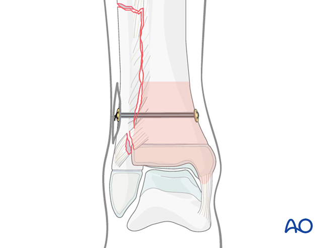 Syndesmotic stabilization
