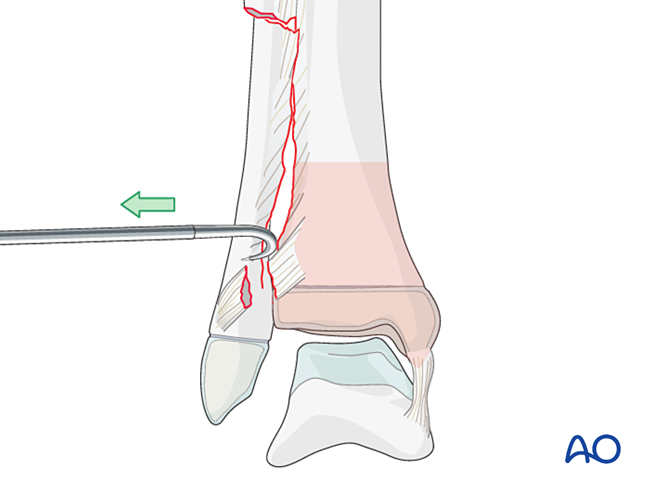 Open reduction; plate fixation for Epi-/metaphyseal fractures (Salter ...