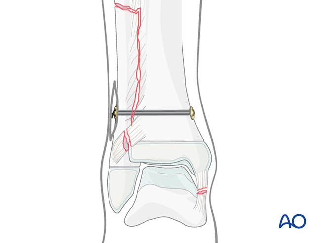 Syndesmotic transfixation with suture and button (suspensory fixation ...