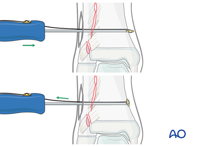 Syndesmotic transfixation with suture and button (suspensory fixation ...