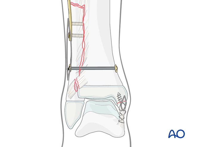 Syndesmotic transfixation with suture and button (suspensory fixation ...
