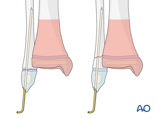 Open reduction; K-wire fixation for Epi-/metaphyseal fractures (Salter ...