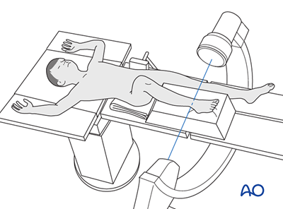 Patient preparation in supine position