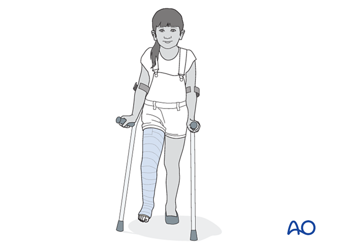 Long leg cast for Epiphyseal fractures (Salter-Harris III) of the ...