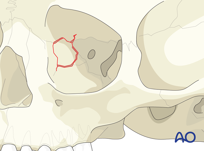 Observation for Medial orbital wall fracture