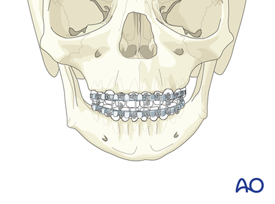 Closed reduction for Palatoalveolar fracture