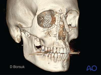 Open reduction internal fixation for NOE fracture