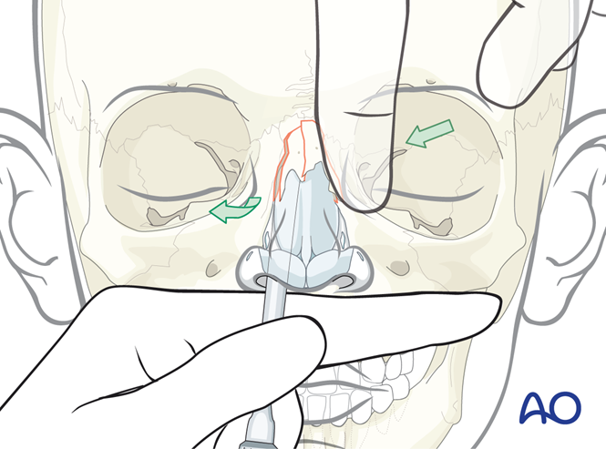 Closed treatment for Nasal bone fracture