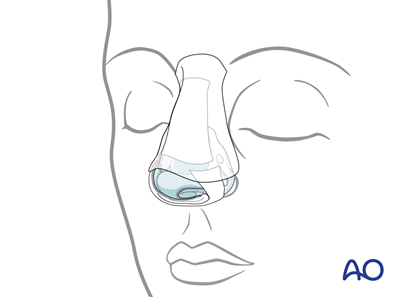 Closed treatment for Nasal bone fracture