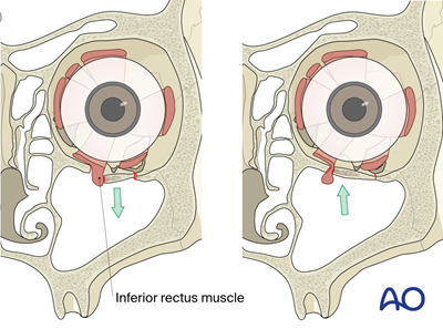 Orbital reconstruction for Orbital floor fracture