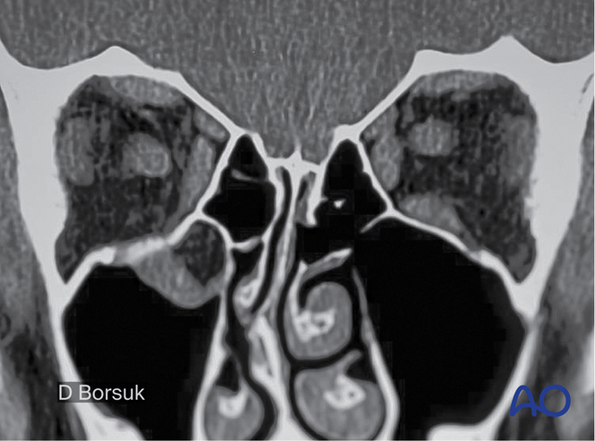 Orbital reconstruction for Orbital floor fracture