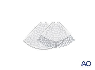 Orbital reconstruction for Orbital floor fracture