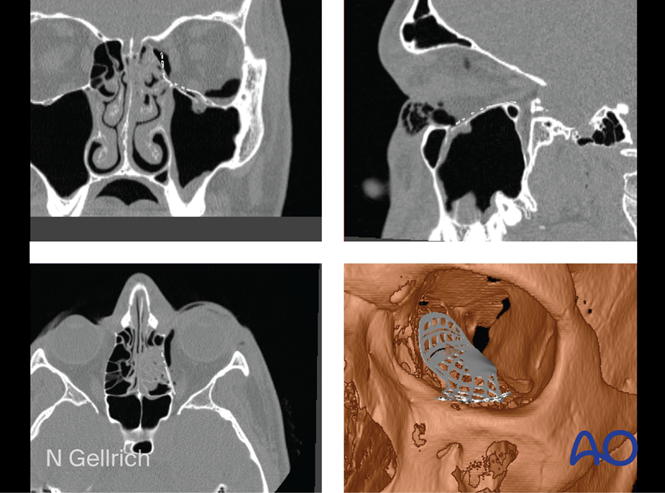 Orbital reconstruction for Orbital floor fracture