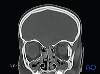 Open treatment for Lateral orbital wall fracture
