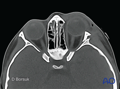 Open treatment for Lateral orbital wall fracture