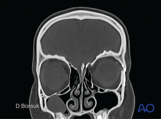 Open treatment for Lateral orbital wall fracture