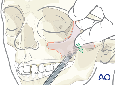 ORIF without orbital reconstruction for Zygomatic complex fracture