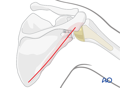 Posterior approach to the scapular body