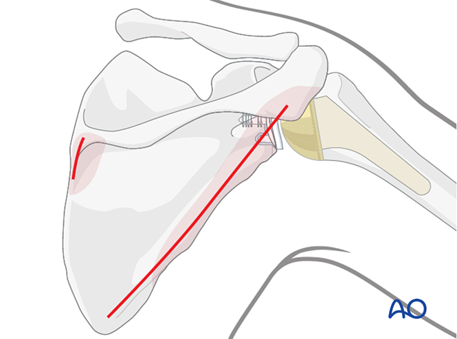 Posterior approach to the scapular body