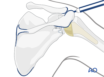Posterior approach to the scapular body