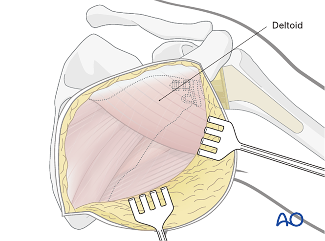 Posterior approach to the scapular body