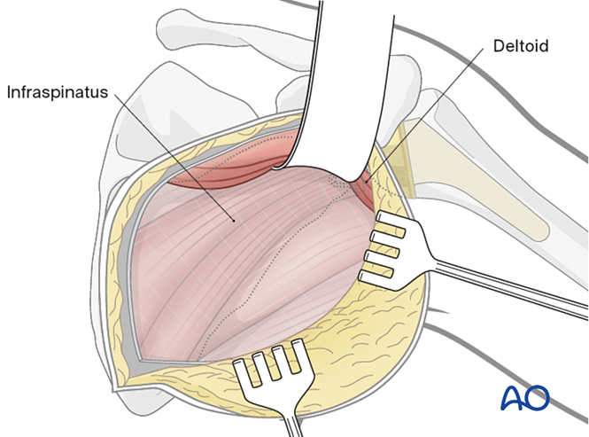 Posterior approach to the scapular body