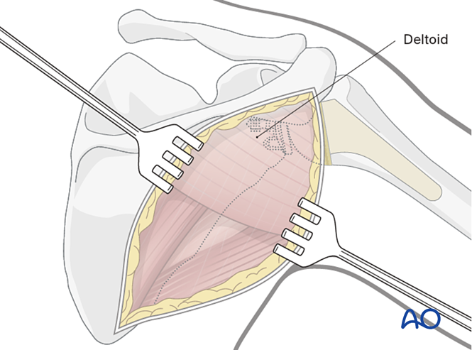 Posterior approach to the scapular body