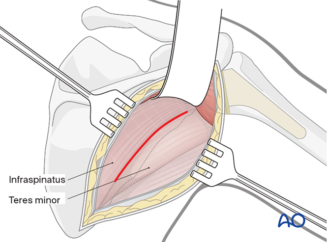 Posterior approach to the scapular body